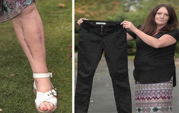 Too Tight Jeans Almost Killed This Woman