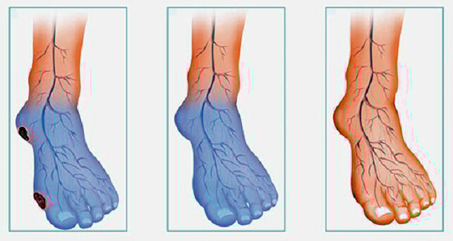 Cold Hands and Legs? How to Solve Poor Blood Circulation