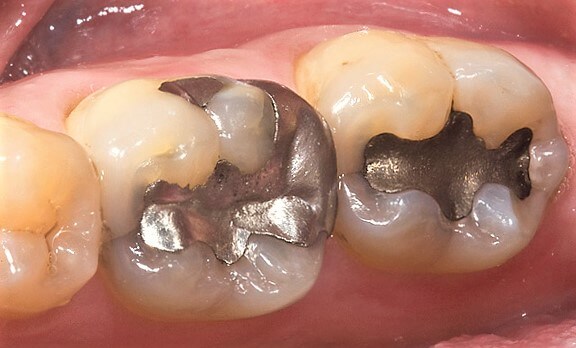 Warning! Remove Amalgam Fillings, They Can Cause Serious Health Disease