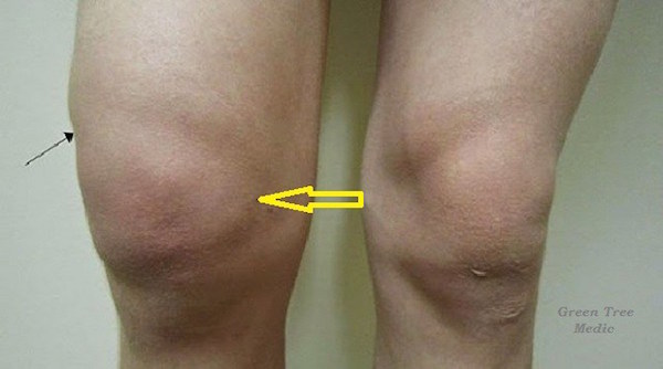 Get Rid Of Water In Your Knee And Knee Pain Naturally!