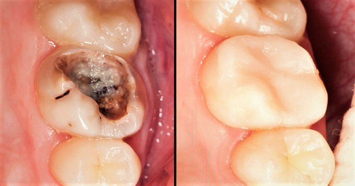 5 Methods to Treat Cavity and Tooth Decay Naturally